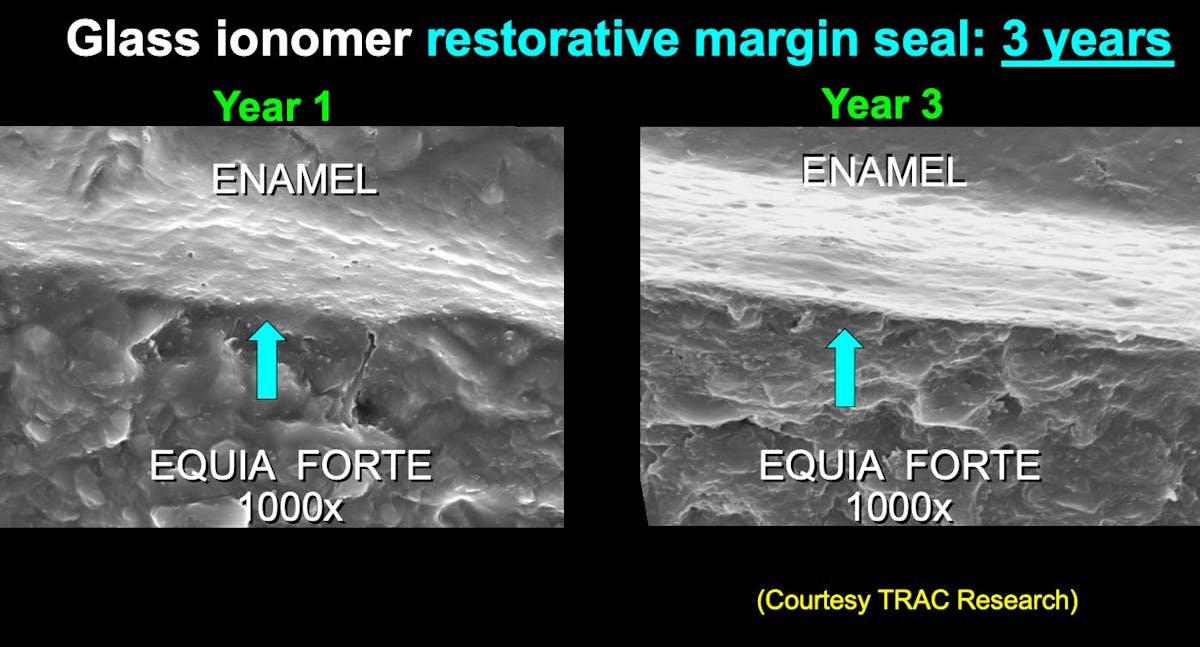 Reducing composite resin failures | Dental Economics