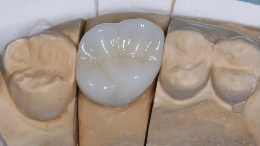 How to reduce recurrent caries and crowns coming off | Dental Economics