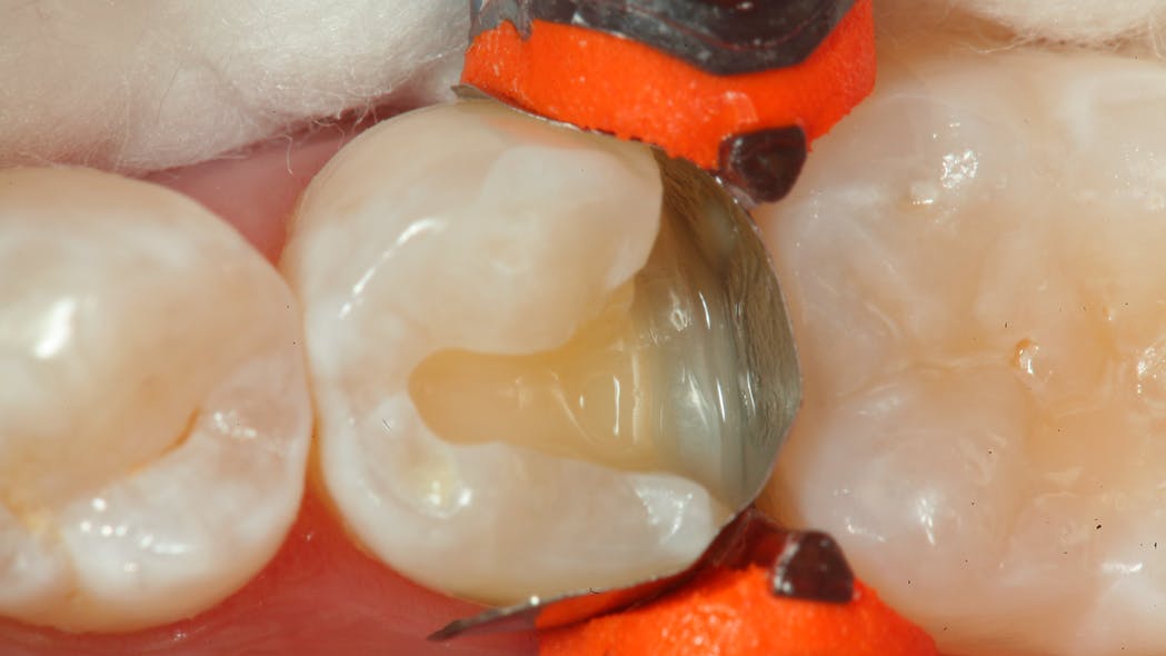 10 years of clinical success with composite resin technology: Case ...