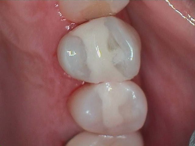 Clinical case studies: Restoring posterior caries lesions on high ...