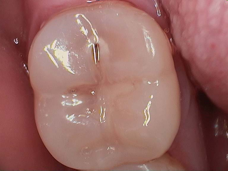 Occlusal Decay