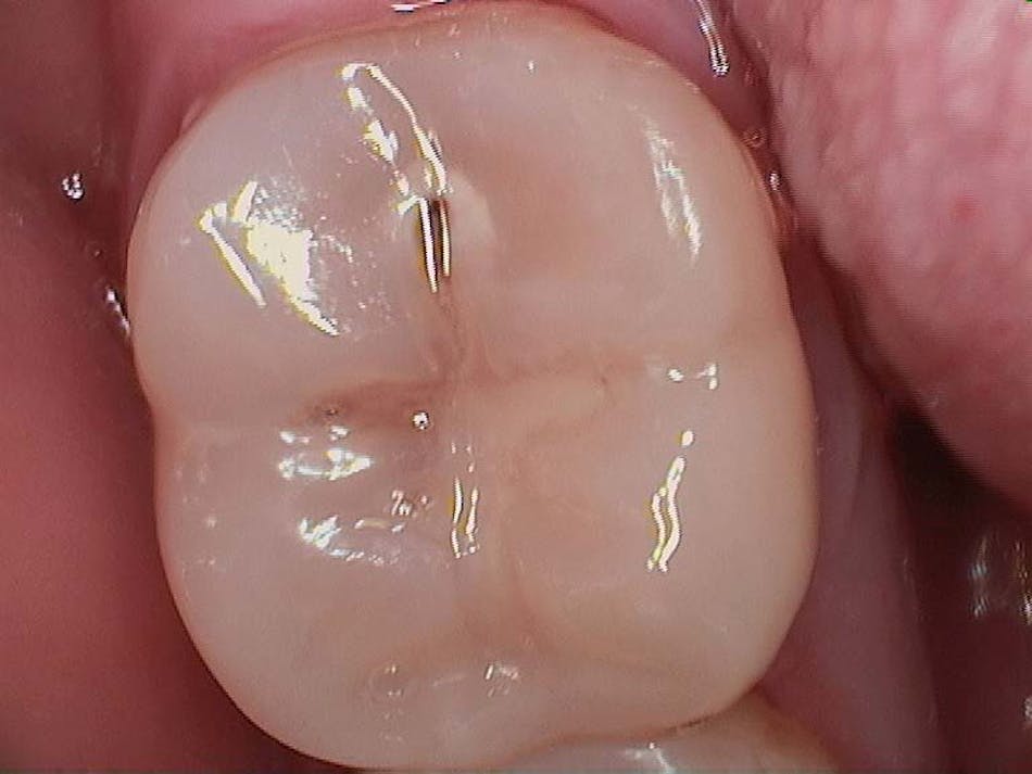 Clinical case studies: Restoring posterior caries lesions on high ...