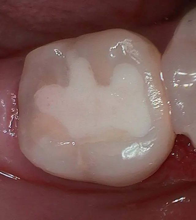 Clinical case studies: Restoring posterior caries lesions on high ...