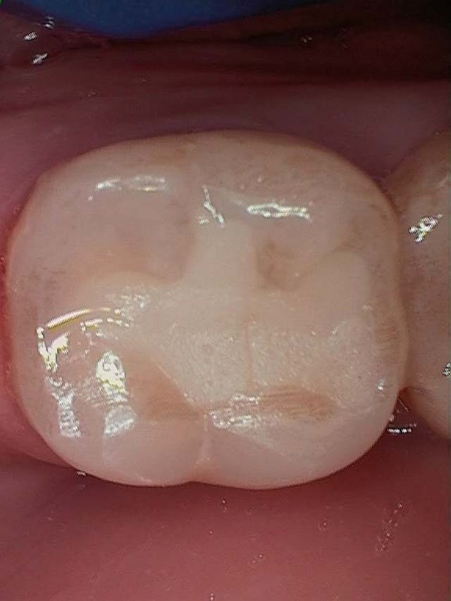 Clinical case studies: Restoring posterior caries lesions on high ...