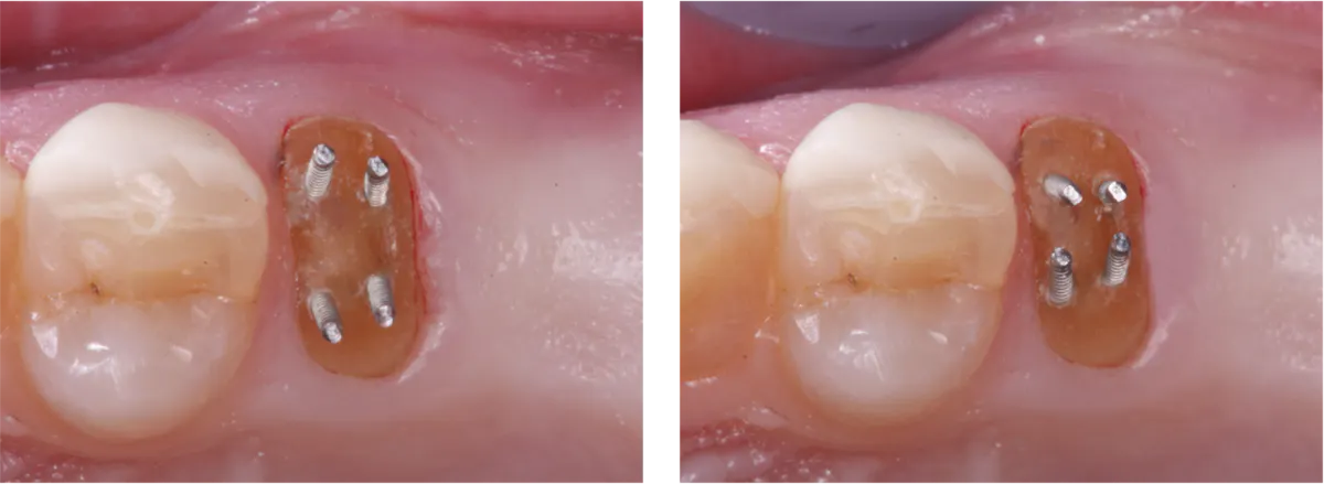 Successful cementing of zirconia crowns: Still a problem | Dental Economics