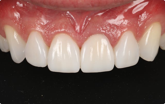 Direct-indirect composite veneers: Balancing esthetics and minimal ...