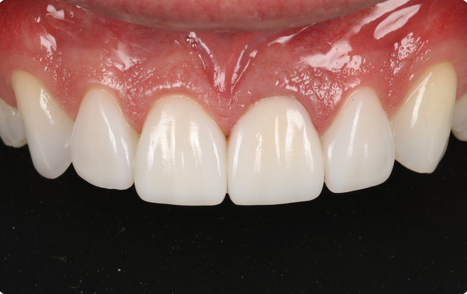 Direct-indirect composite veneers: Balancing esthetics and minimal ...