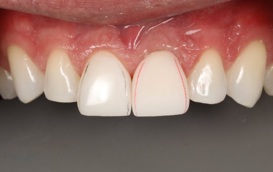 Direct-indirect composite veneers: Balancing esthetics and minimal ...