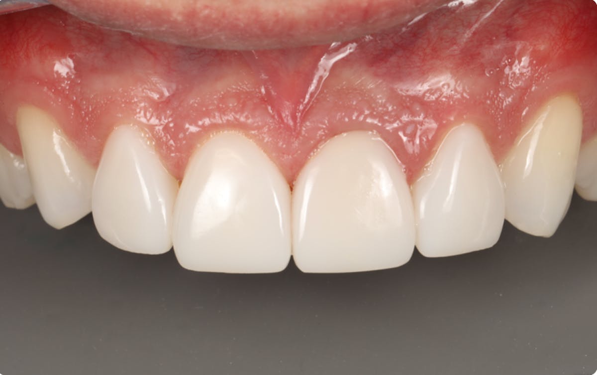 Direct-indirect composite veneers: Balancing esthetics and minimal ...