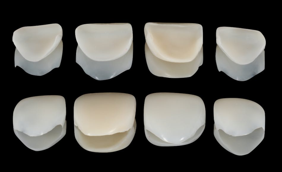 Direct-indirect composite veneers: Balancing esthetics and minimal ...