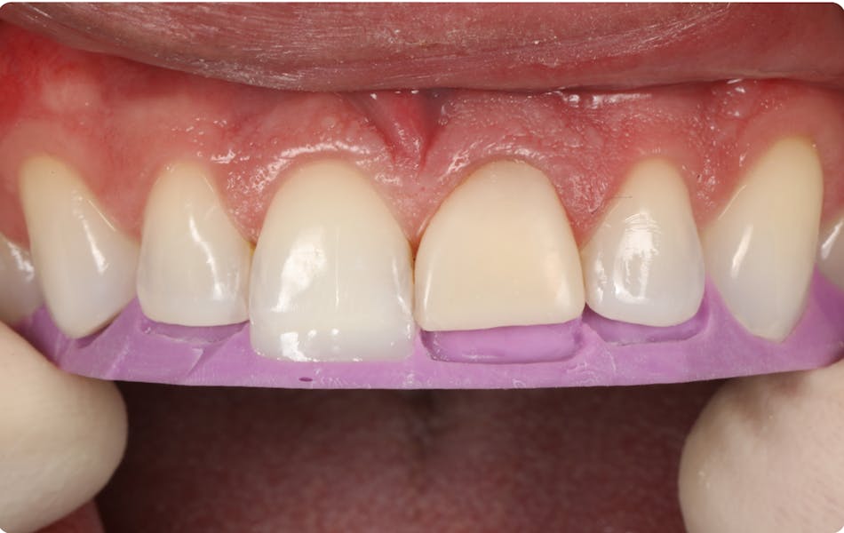 Direct-indirect composite veneers: Balancing esthetics and minimal ...