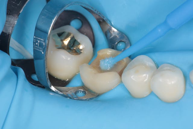 Rubber dam: A key to better esthetic dentistry | Dental Economics
