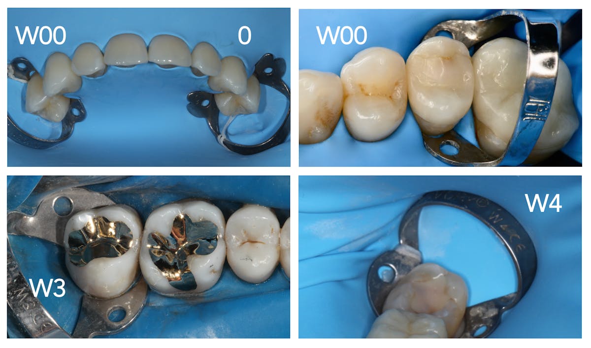 Rubber dam: A key to better esthetic dentistry | Dental Economics