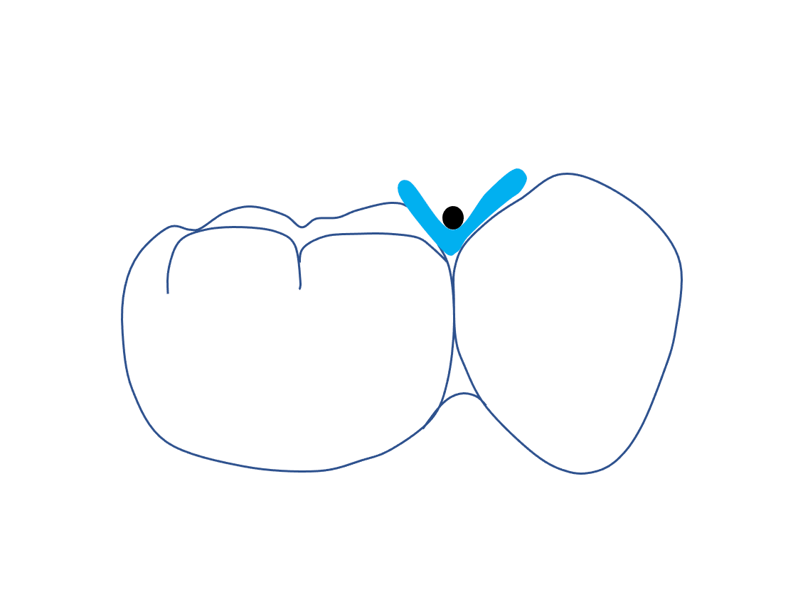 Rubber dam: A key to better esthetic dentistry | Dental Economics