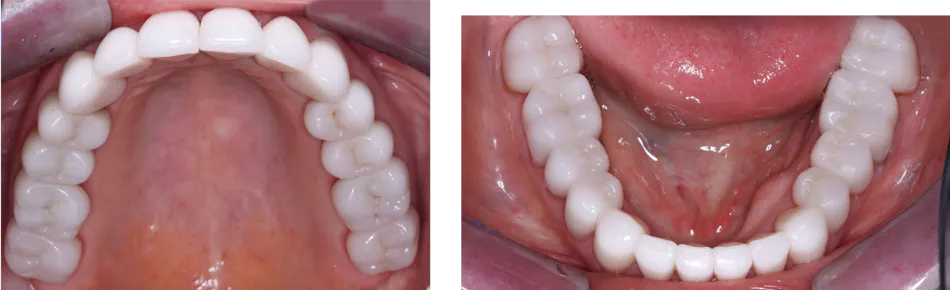 Occlusion and caries: Continuing zirconia challenges | Dental Economics