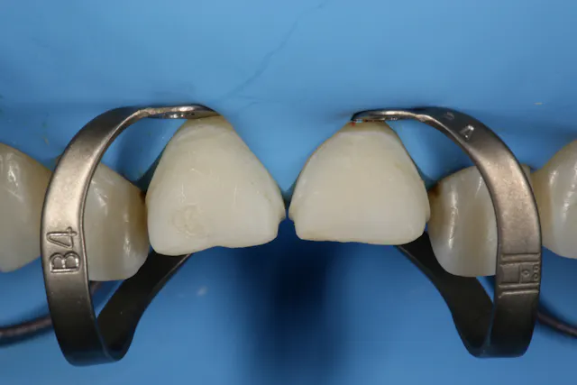 Rubber dam: A key to better esthetic dentistry | Dental Economics