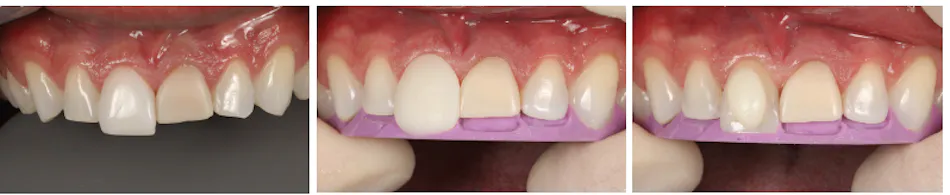 Direct-indirect composite veneers: Balancing esthetics and minimal ...