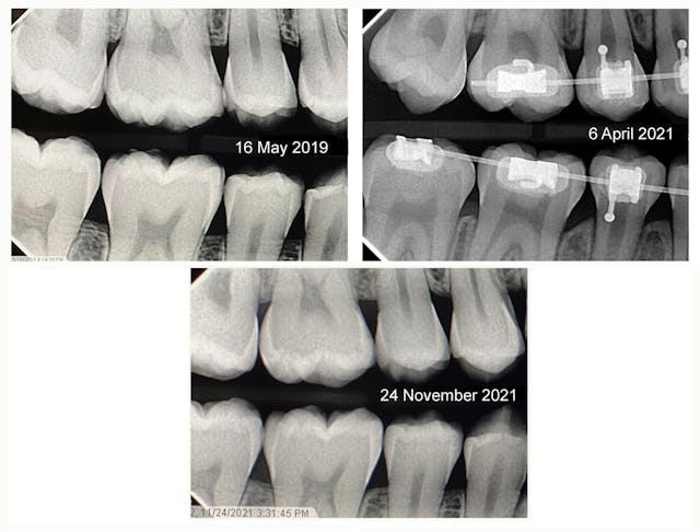 SDF application on posterior contacting axial surfaces in orthodontic ...