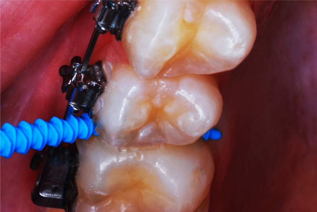 SDF application on posterior contacting axial surfaces in orthodontic ...