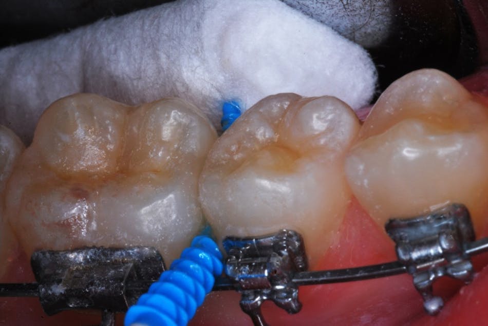 SDF application on posterior contacting axial surfaces in orthodontic ...