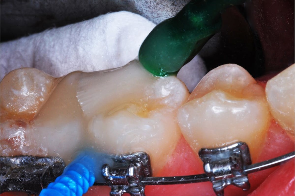 SDF application on posterior contacting axial surfaces in orthodontic ...