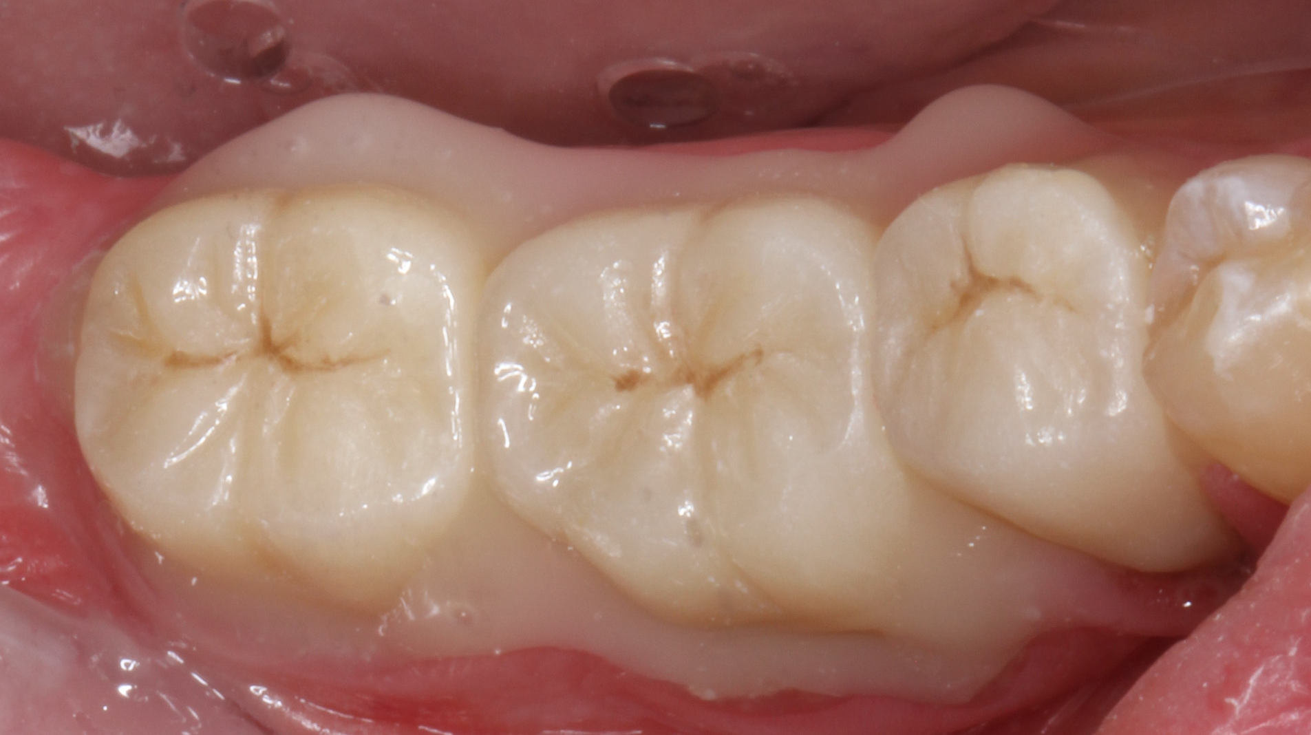 Dental cementation: Evolution to revolution in everyday dentistry ...