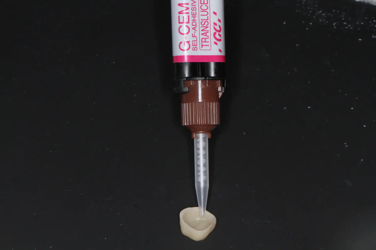 Dental cementation: Evolution to revolution in everyday dentistry ...