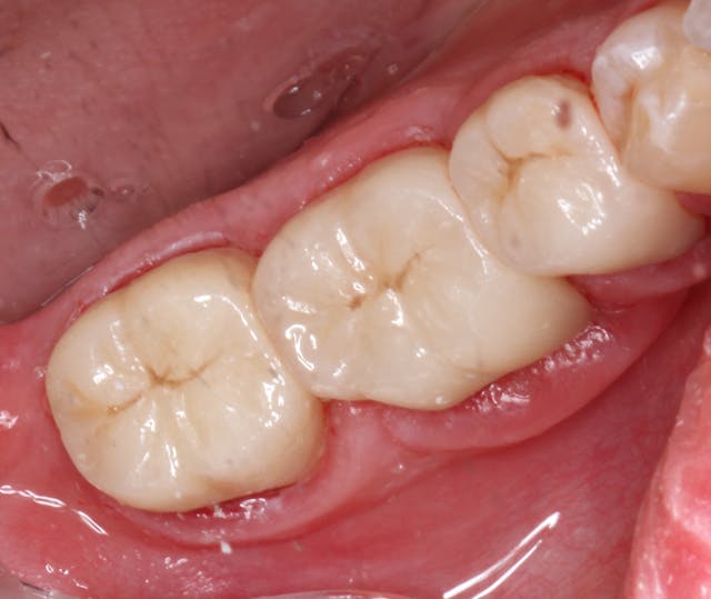 Dental cementation: Evolution to revolution in everyday dentistry ...