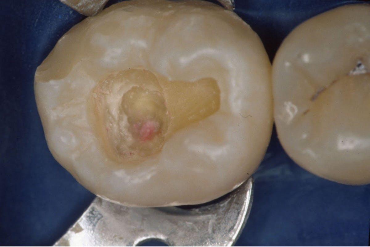 Has pulp capping been replaced by endo treatment? | Dental Economics