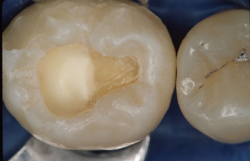 Has pulp capping been replaced by endo treatment? | Dental Economics