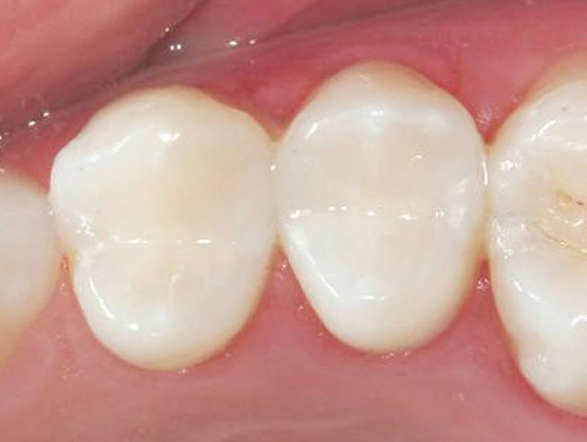 Reducing composite resin failures | Dental Economics