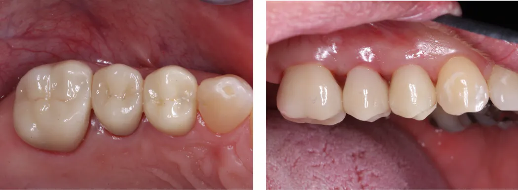 Solving challenges with zirconia and lithium disilicate crowns | Dental ...