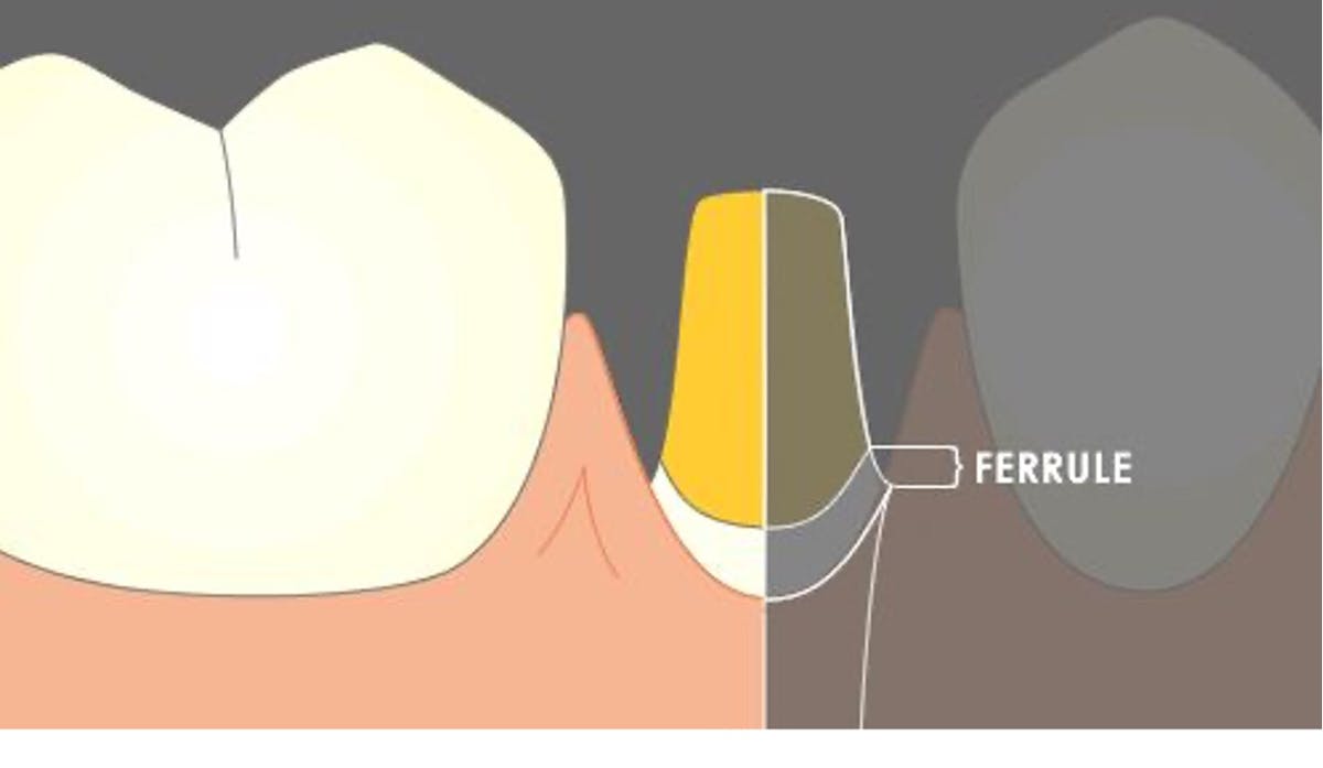 Why should teeth be removed? | Dental Economics