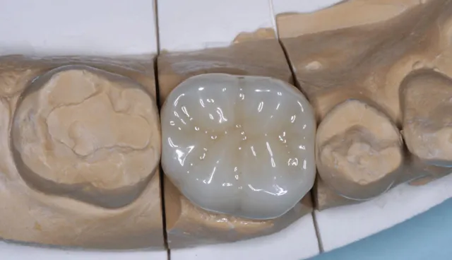 Solving zirconia occlusion challenges | Dental Economics