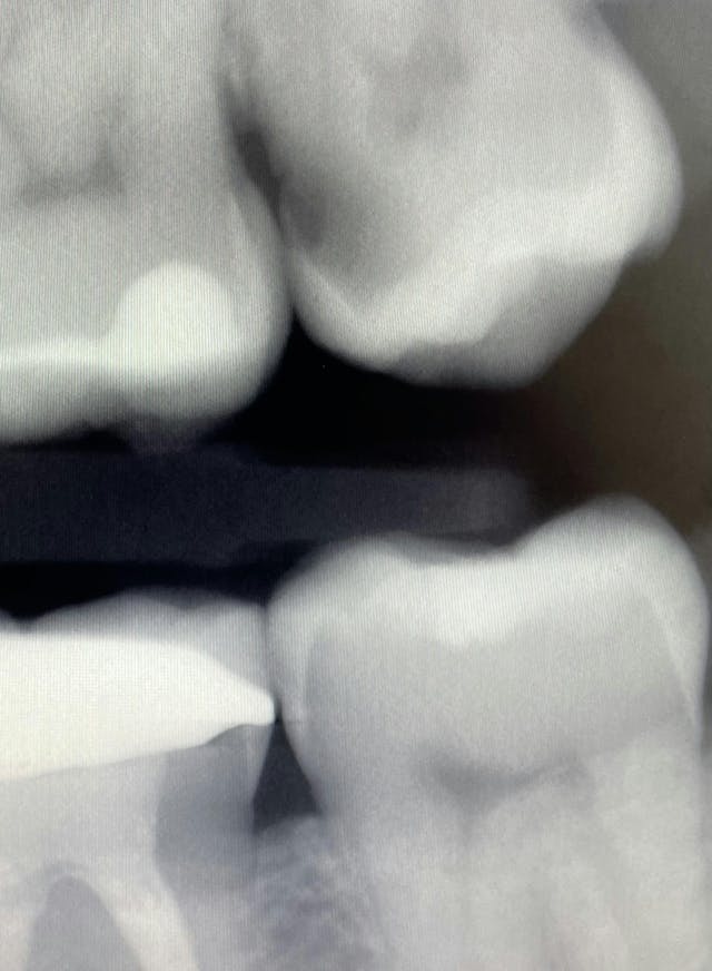 3D tomosynthesis: The future of dental imaging allows you to see more ...