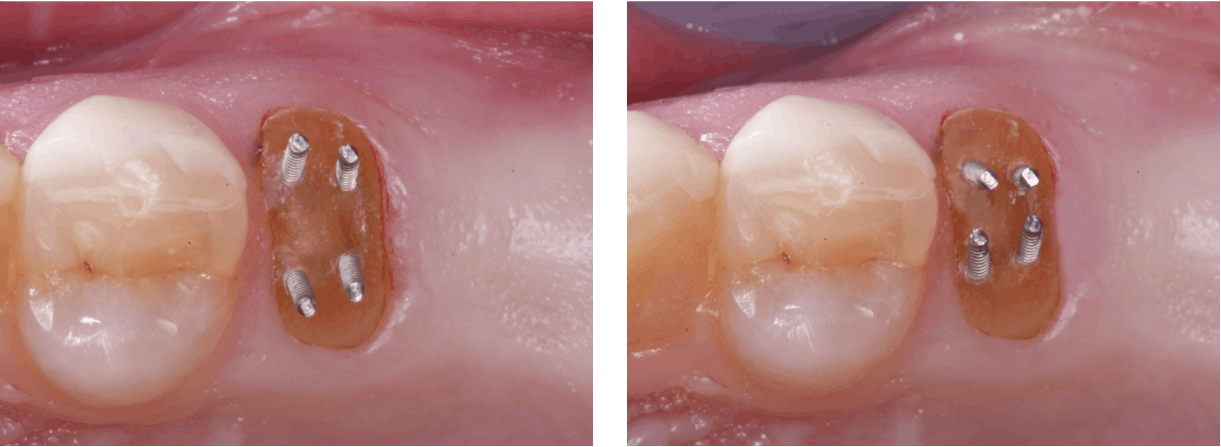 Obtaining optimum retention for tooth restorations | Dental Economics