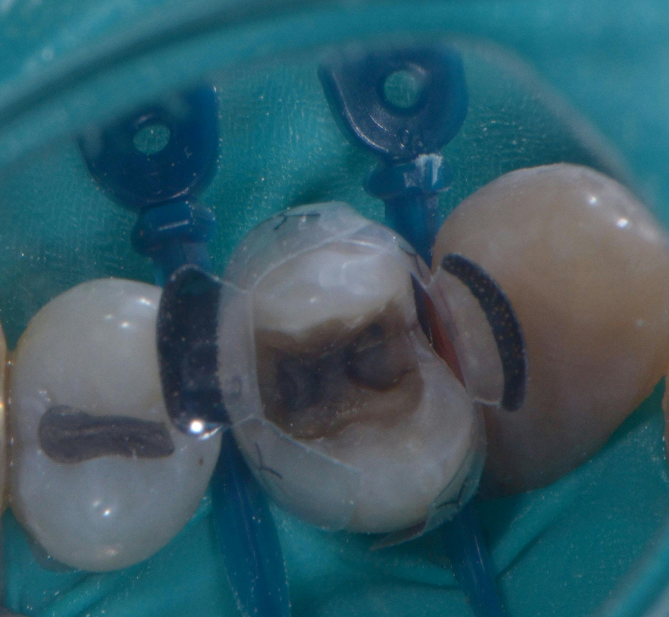 Advances in direct composite placement | Dental Economics