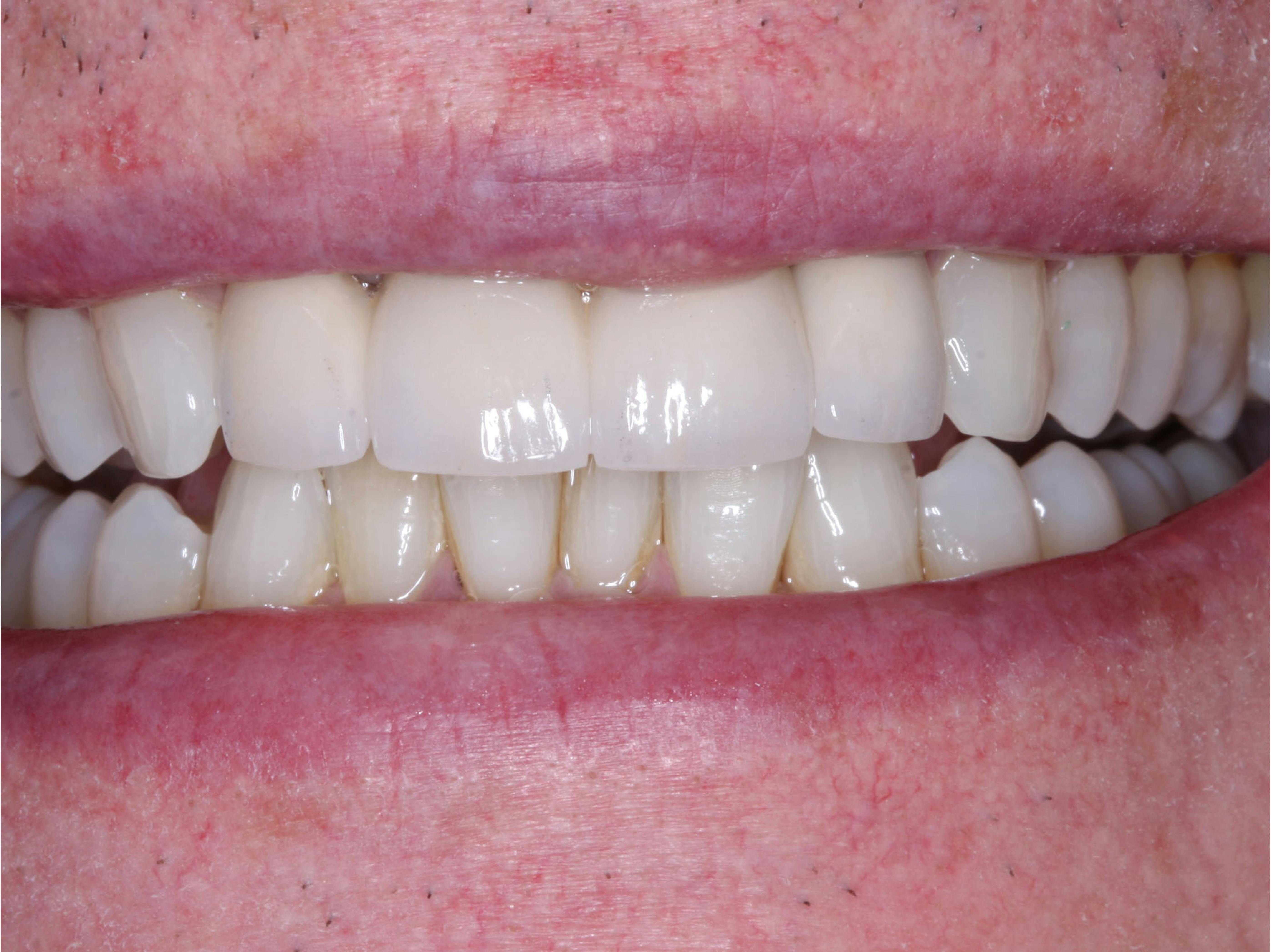 New restoration types make occlusion knowledge mandatory | Dental Economics